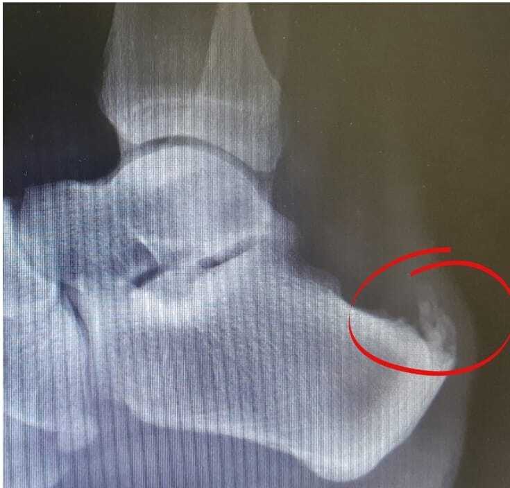 Tendinite de Aquiles: O que é e como tratar o tendão do calcâneo - Dr ...